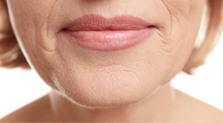 How to Get Rid of Smoker Lines: Top Treatments and Tips | Beso Aesthetics