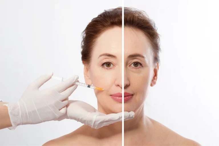 How to Get Rid of Smoker Lines: Top Treatments and Tips | Beso Aesthetics
