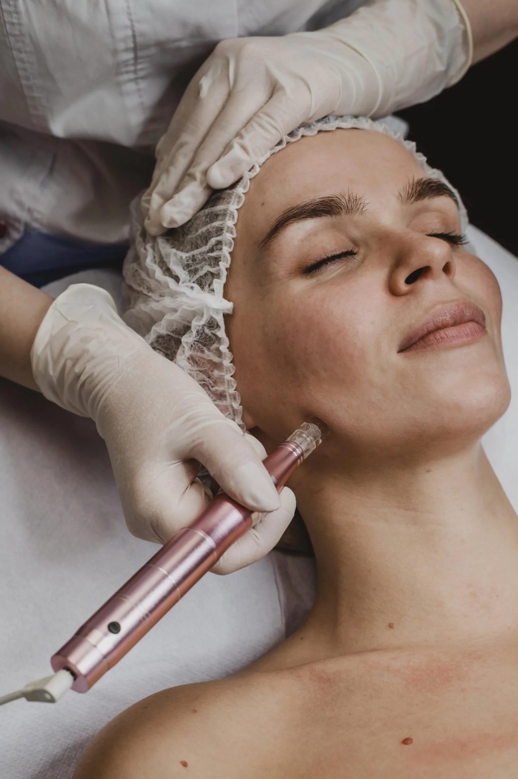 Scar Microneedling NYC | Beso Aesthetics